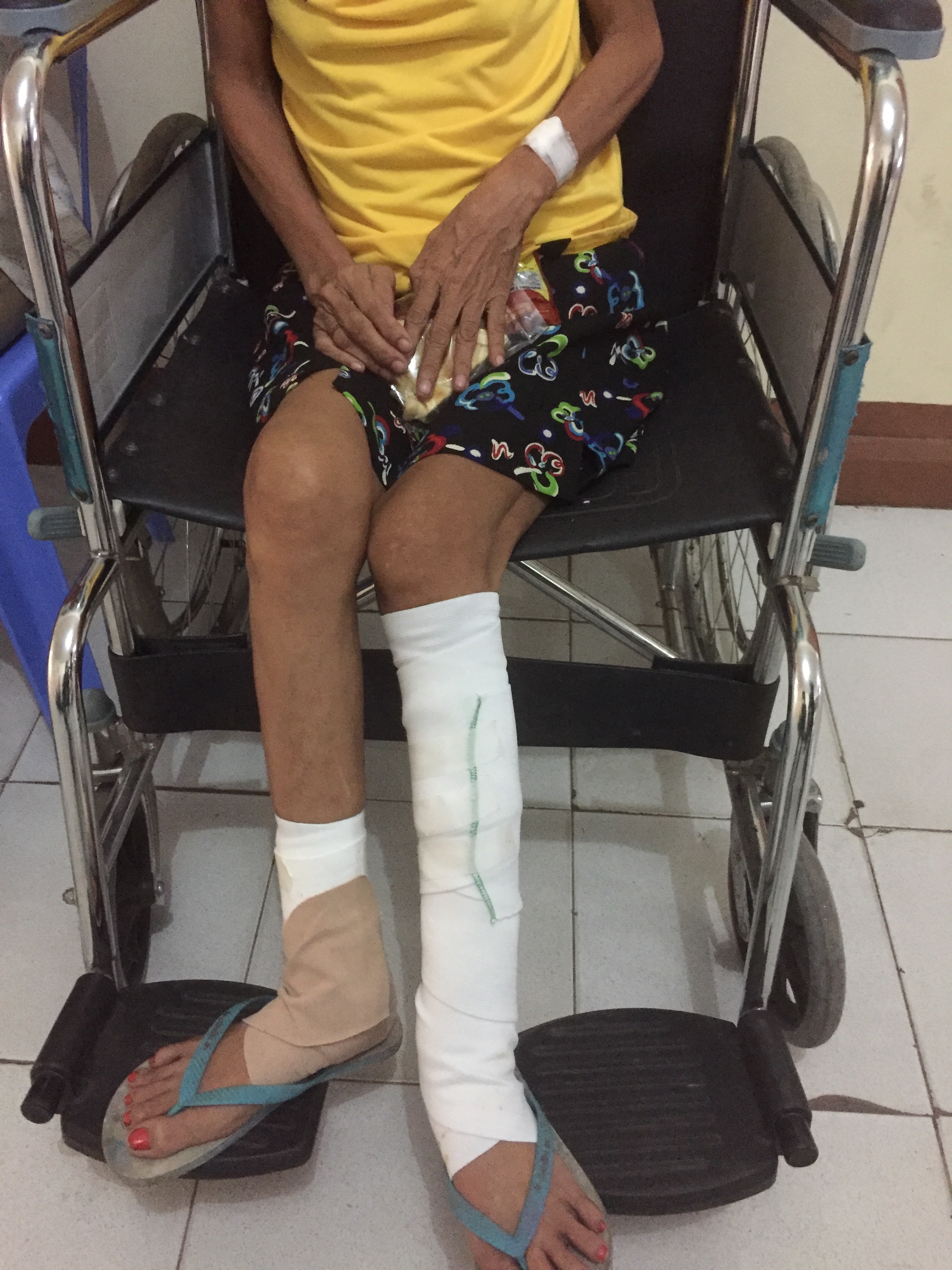 A medical mission and the lady with the external fixators | Inquirer