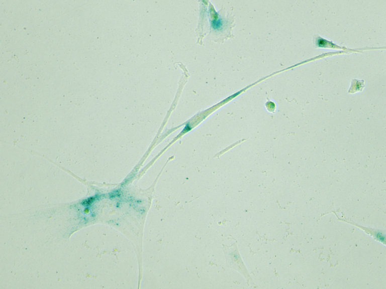 What are Zombie Cells and Are They the Key to Anti-Aging?