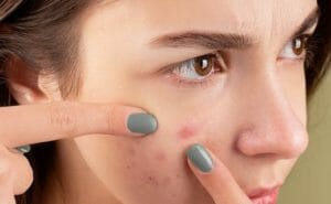 Does Vaping Cause Acne? | Inquirer