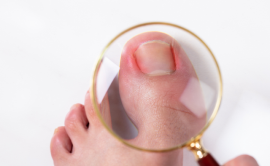 Ingrown Toenail Removal: Step-by-Step Safe and Effective Guide