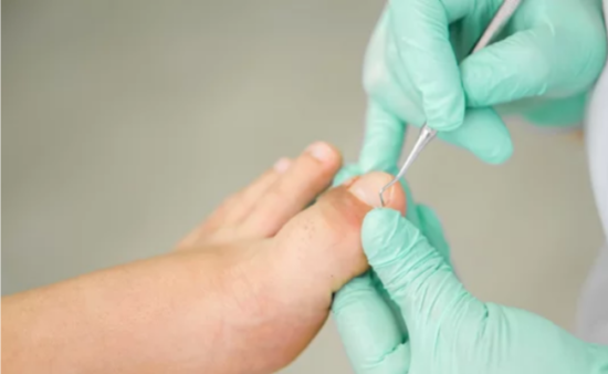Ingrown Toenail Removal: Step-by-Step Safe and Effective Guide